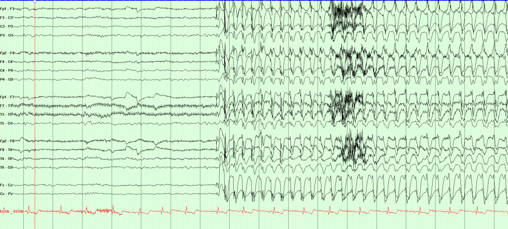 Epilepsy Exam Review, with Practice Questions | NowYouKnow Neuro