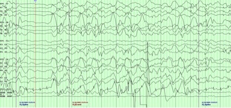 Learn to Read EEG , with practice questions! | NowYouKnow Neuro
