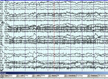 Learn to Read EEG , with practice questions! | NowYouKnow Neuro