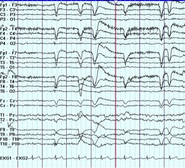 Learn to Read EEG , with practice questions! | NowYouKnow Neuro