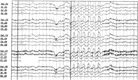 Learn to Read EEG , with practice questions! | NowYouKnow Neuro