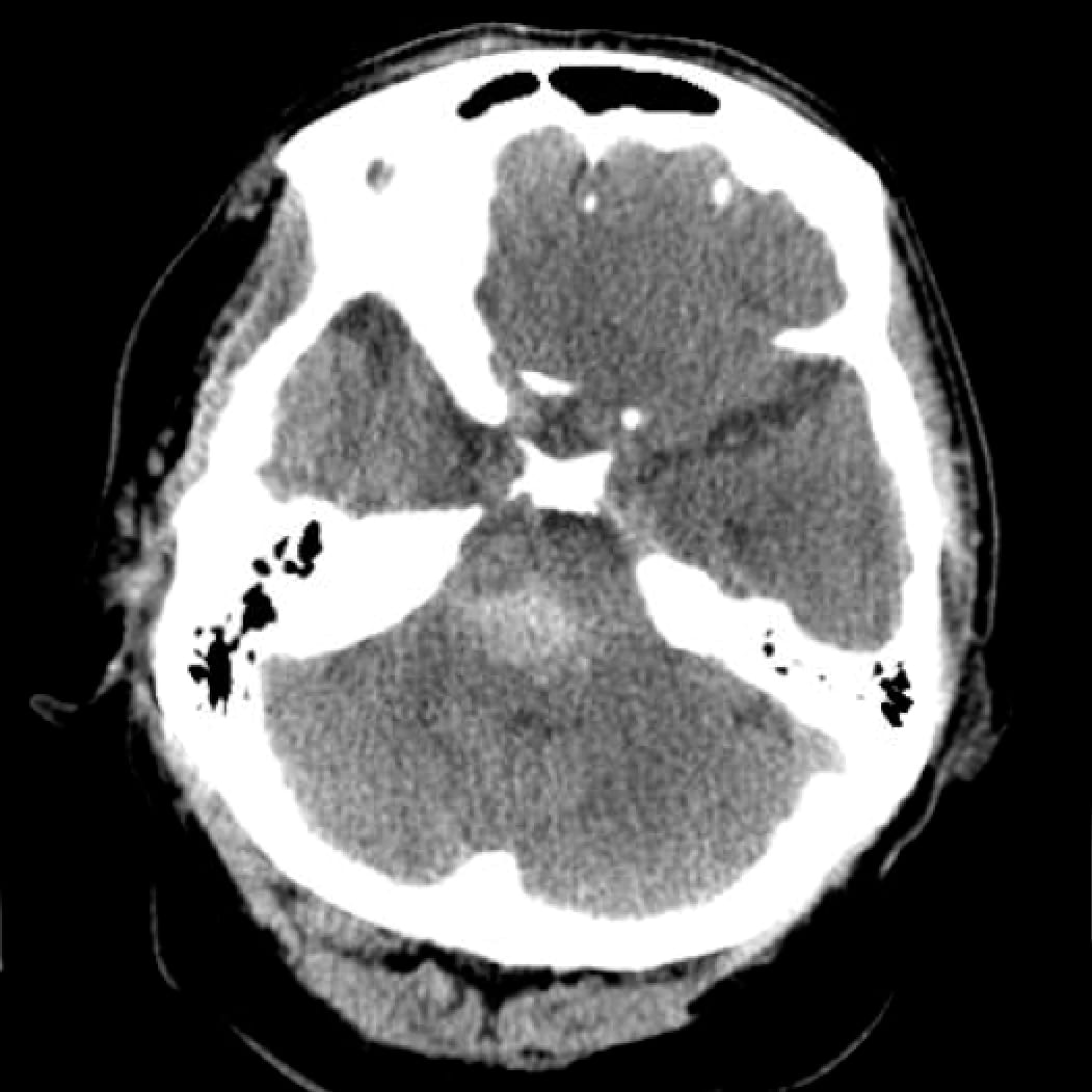 Vascular Neurology | Review and Quiz | NowYouKnow Neuro