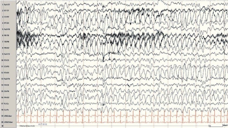 EEG | NowYouKnow Neuro