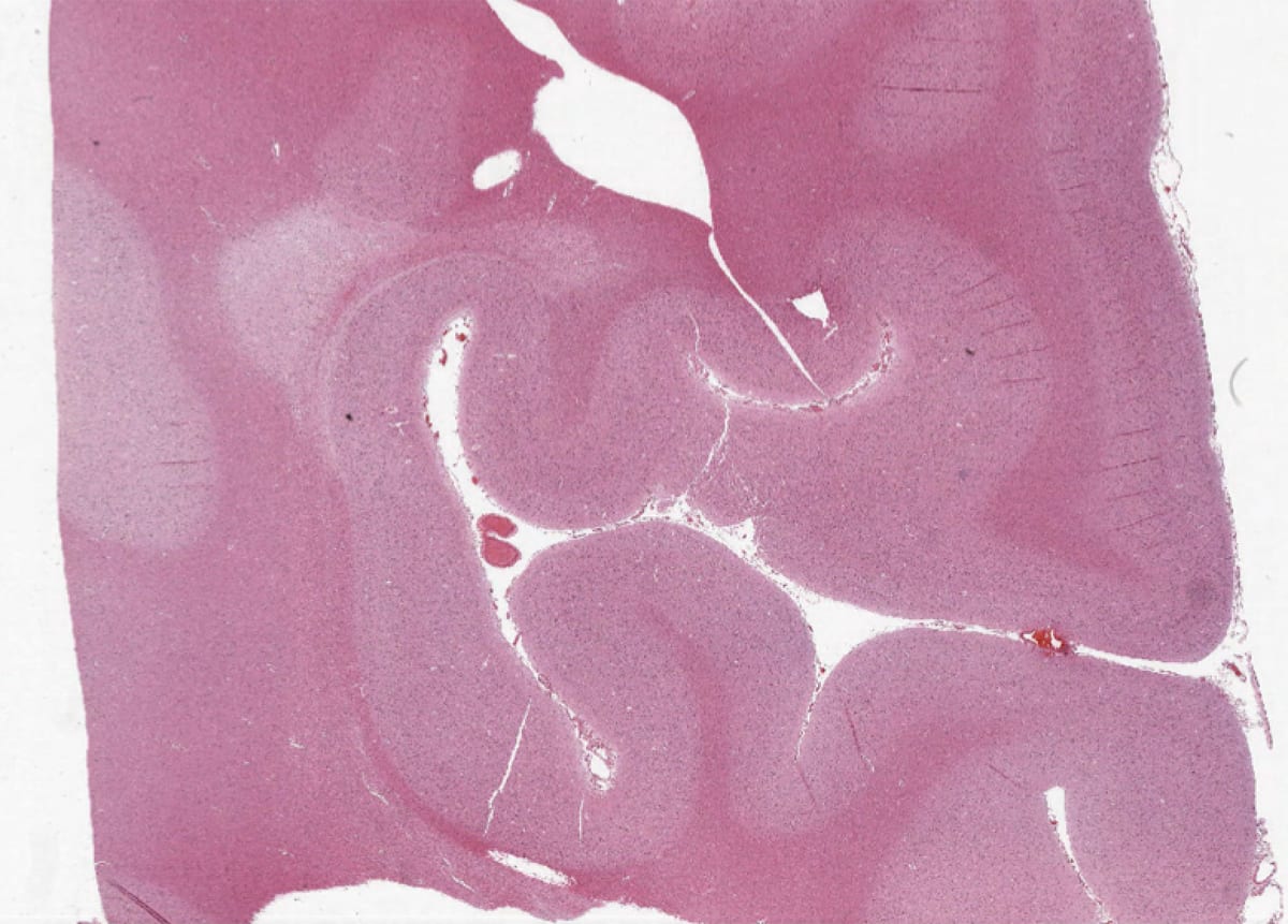 Demyelinating Disease Review and Quiz | NowYouKnow Neuro