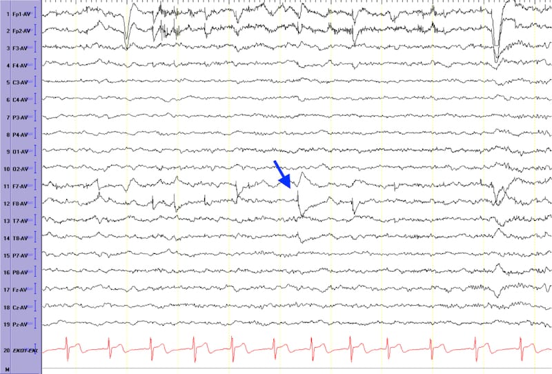 eeg baseline | NowYouKnow Neuro