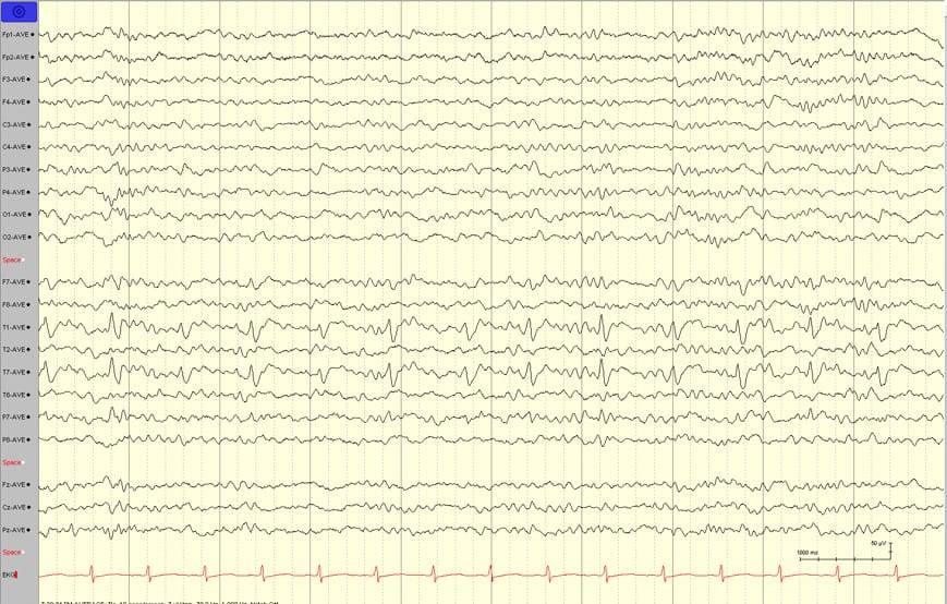 Learn to Read EEG , with practice questions! | NowYouKnow Neuro