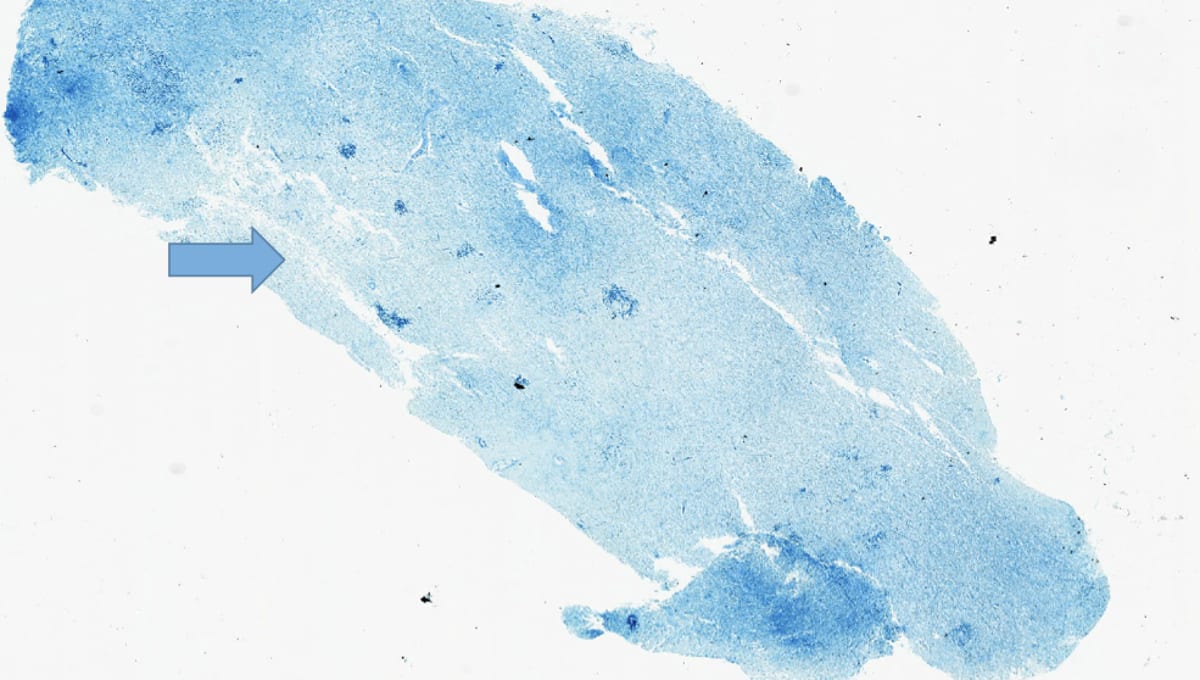 Demyelinating Disease Review and Quiz | NowYouKnow Neuro