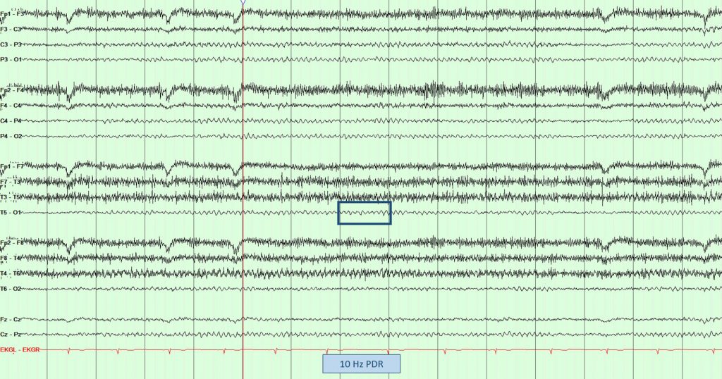Learn to Read EEG , with practice questions! | NowYouKnow Neuro