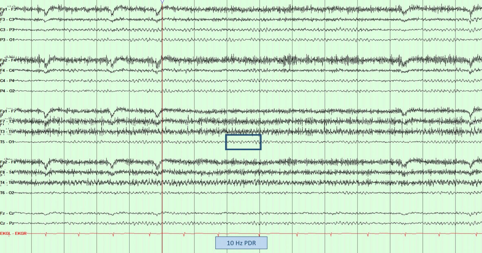 Learn to Read EEG , with practice questions! | NowYouKnow Neuro
