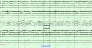 Learn to Read EEG , with practice questions! | NowYouKnow Neuro