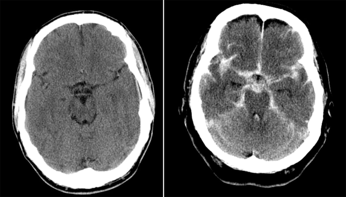 Headache Review | Chapter with Questions | NowYouKnow Neuro