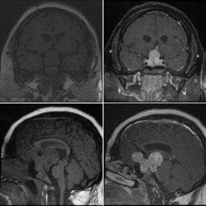 Tumors & Cysts | NowYouKnow Neuro