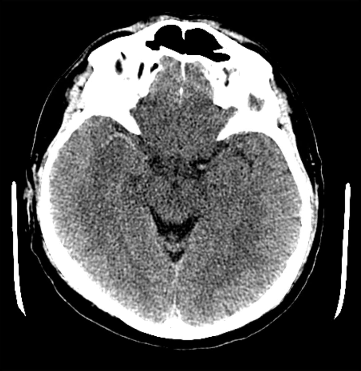 High Yield Neuroradiology - Over 200 Images! | NowYouKnow Neuro