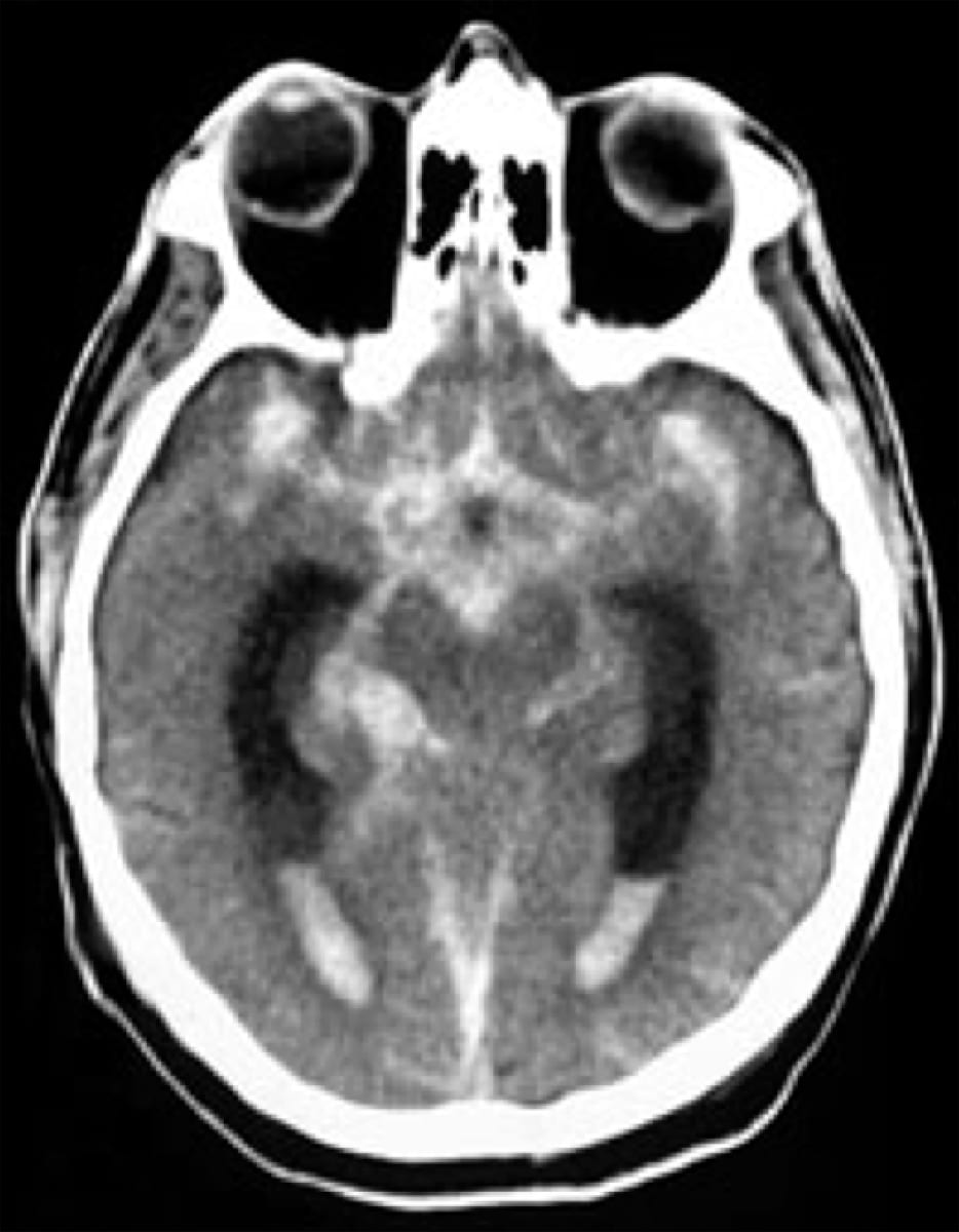 Headache Review | Chapter with Questions | NowYouKnow Neuro