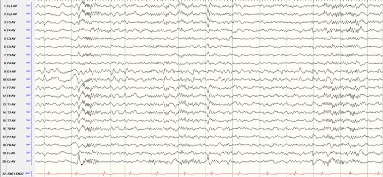 Sleep Disorders Neuro Review | Chapter and Quiz | NowYouKnow Neuro